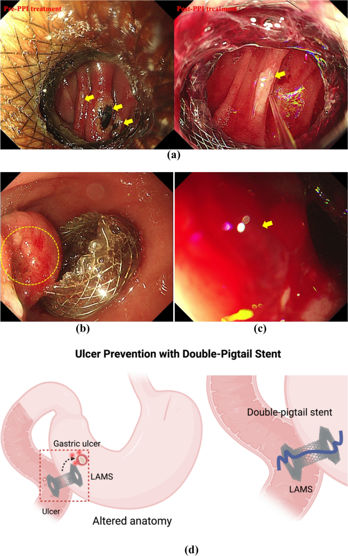 Fatal Postoperative Bleeding After Endoscopic Ultrasound-Guided ...