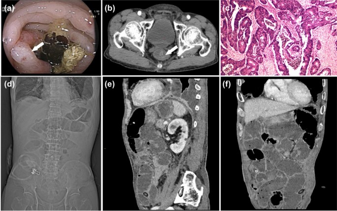 Postoperative Intestinal Obstruction Relieved by Stoma Endoscopic ...