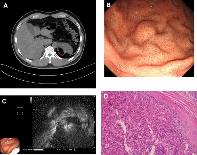 Ectopic Spleen in the Gastric Fundus | Digestive Diseases and Sciences ...