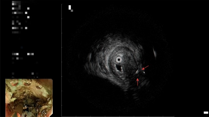 Endoscopic Submucosal Dissection with Real-Time Endoscopic Ultrasound ...