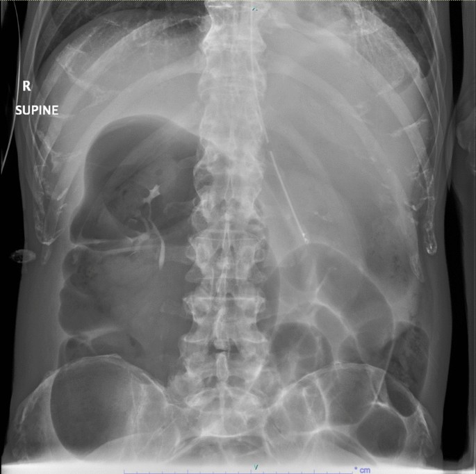 Cecal Volvulus Mimicking Small Bowel Obstruction—A Diagnostic Dilemma ...