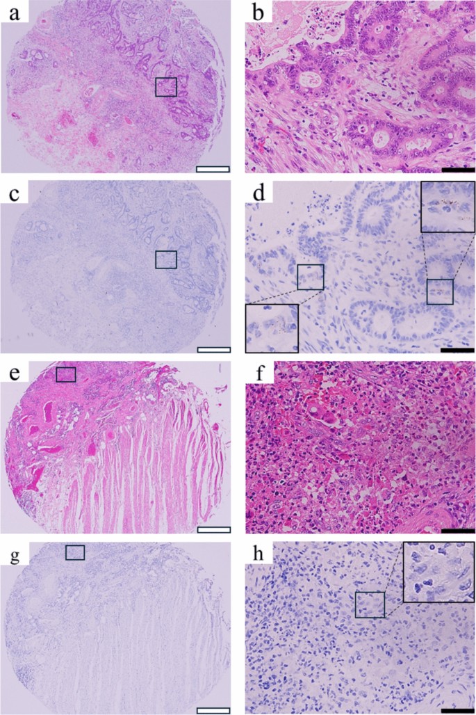 High INHBB Expression Shapes an Immunosuppressive Tumor ...