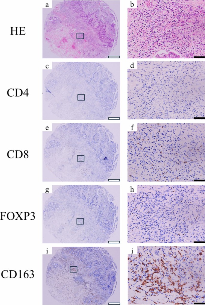 High INHBB Expression Shapes an Immunosuppressive Tumor ...