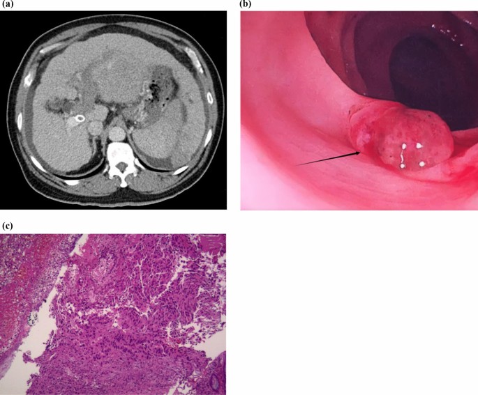Colorectal Metastasis of Hepatocellular Carcinoma Mimicking Yamada Type ...