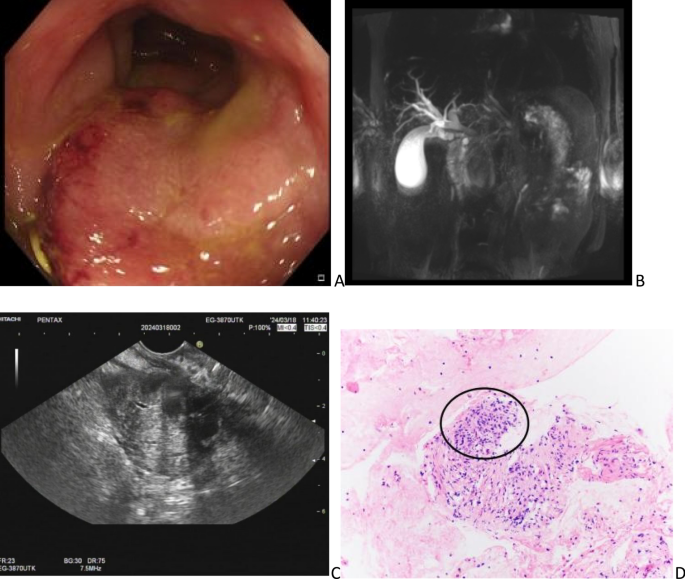 Colonic Stricture as the Initial Manifestation of IgG4-Related Disease ...
