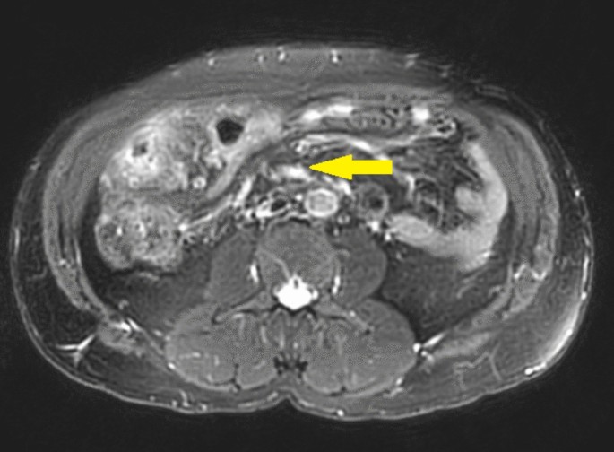 Isolated Right Mesocolic Nodal Metastasis After Low Anterior Resection ...