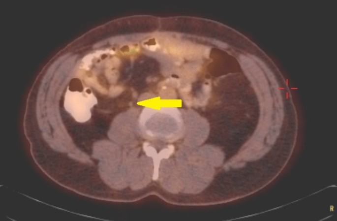Isolated Right Mesocolic Nodal Metastasis After Low Anterior Resection ...