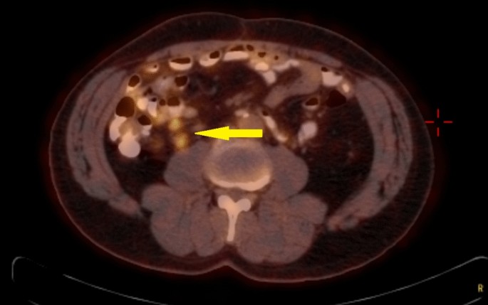 Isolated Right Mesocolic Nodal Metastasis After Low Anterior Resection ...