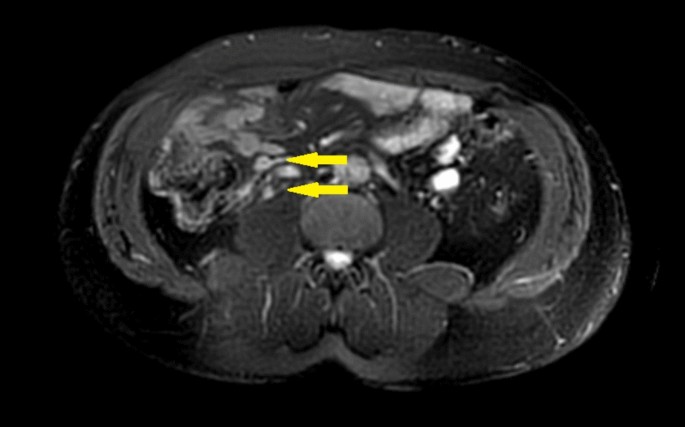Isolated Right Mesocolic Nodal Metastasis After Low Anterior Resection ...