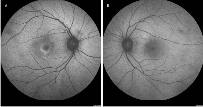 Unilateral best vitelliform macular dystrophy- a case series ...