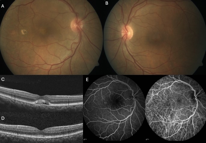Unilateral best vitelliform macular dystrophy- a case series ...