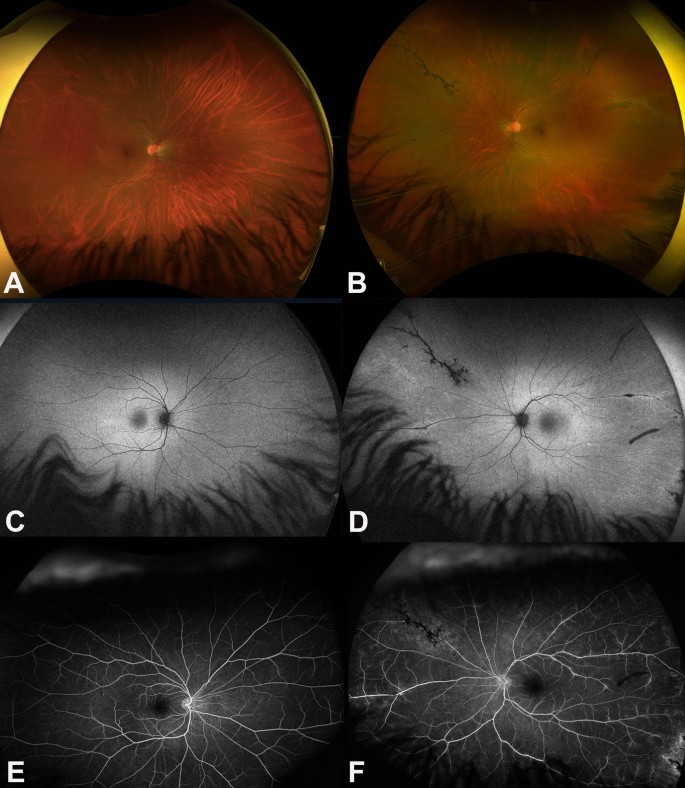 A unilateral presentation of pigmented paravenous chorioretinal atrophy ...