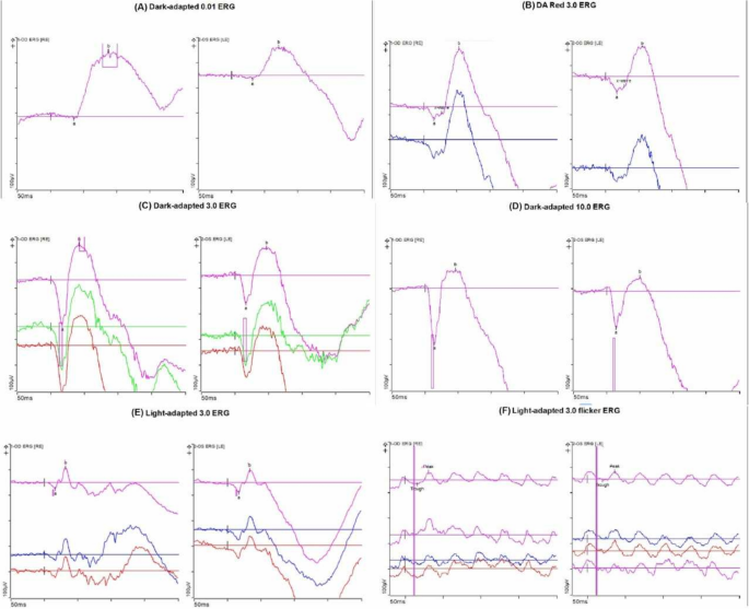 A unilateral presentation of pigmented paravenous chorioretinal atrophy ...