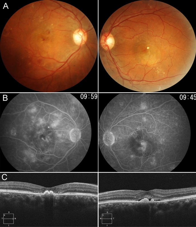 Best vitelliform macular dystrophy caused by a BEST1 p.(Ser246Asn ...