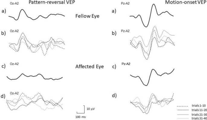 Comparison of visual evoked potential variability in eyes affected by ...