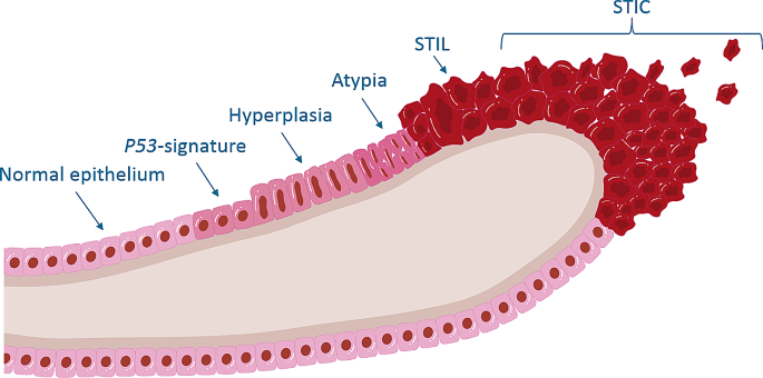Risk-reducing salpingectomy with delayed oophorectomy to prevent ...
