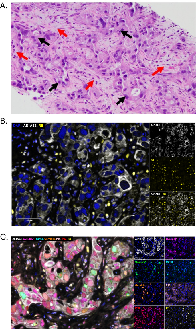 Pancreatic adenocarcinoma in a patient with a germline RB1 pathogenic ...