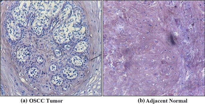 Implicating clinical utility of altered expression of PTCH1 & SMO in ...