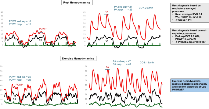 Evaluation of pulmonary hypertension in heart failure with preserved ...