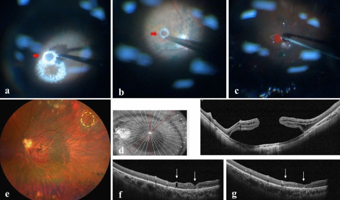 Comparison of the therapeutic effects of lens capsular flap ...