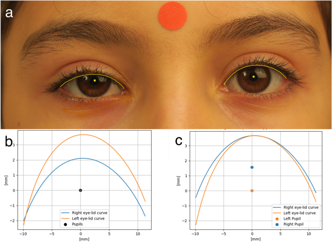 Chasing the objective upper eyelid symmetry formula; R2, RMSE, POC, MAE ...