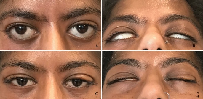 Lower eyelid retraction repair using autologous auricular scapha ...