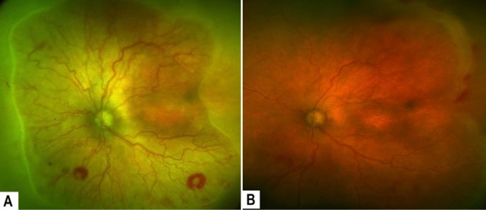 Comparison of intravitreal bevacizumab monotherapy and combined laser ...