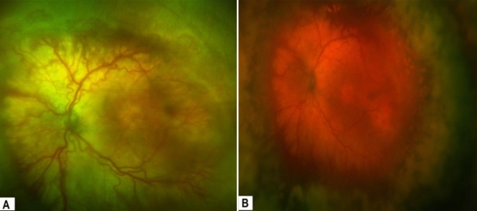 Comparison of intravitreal bevacizumab monotherapy and combined laser ...