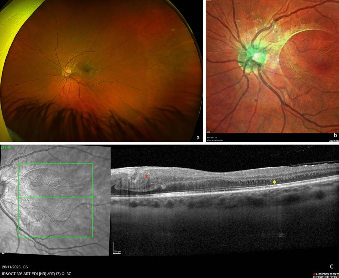 Epiretinal membranes in patients with uveitis: an update on the current ...