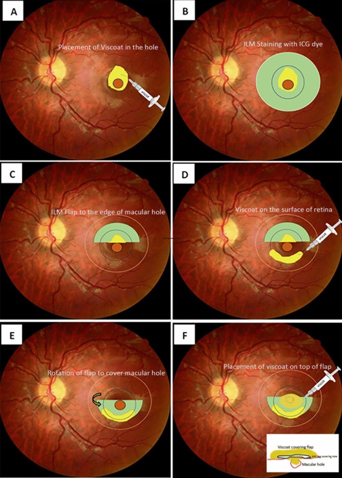 Macular hole repair using a refined viscoelastic assisted membrane ...