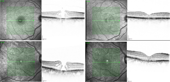 Macular hole repair using a refined viscoelastic assisted membrane ...