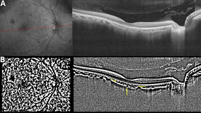 Evaluation of choroidal vascularity index and choroidal thickness in ...
