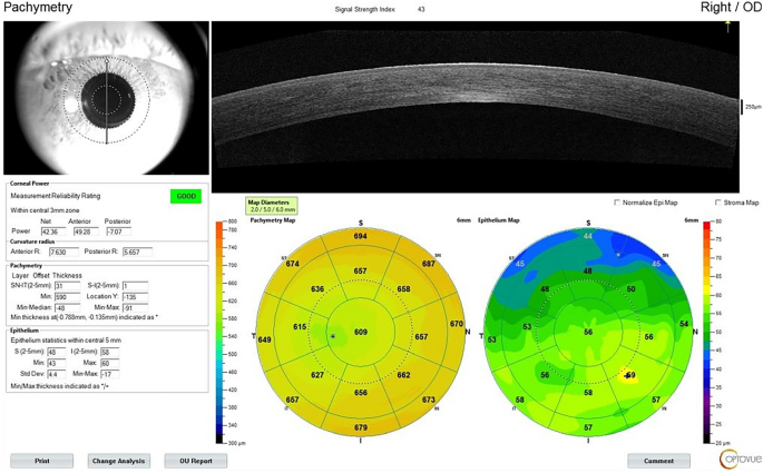 Evaluation of corneal epithelial thickness by anterior segment optical ...