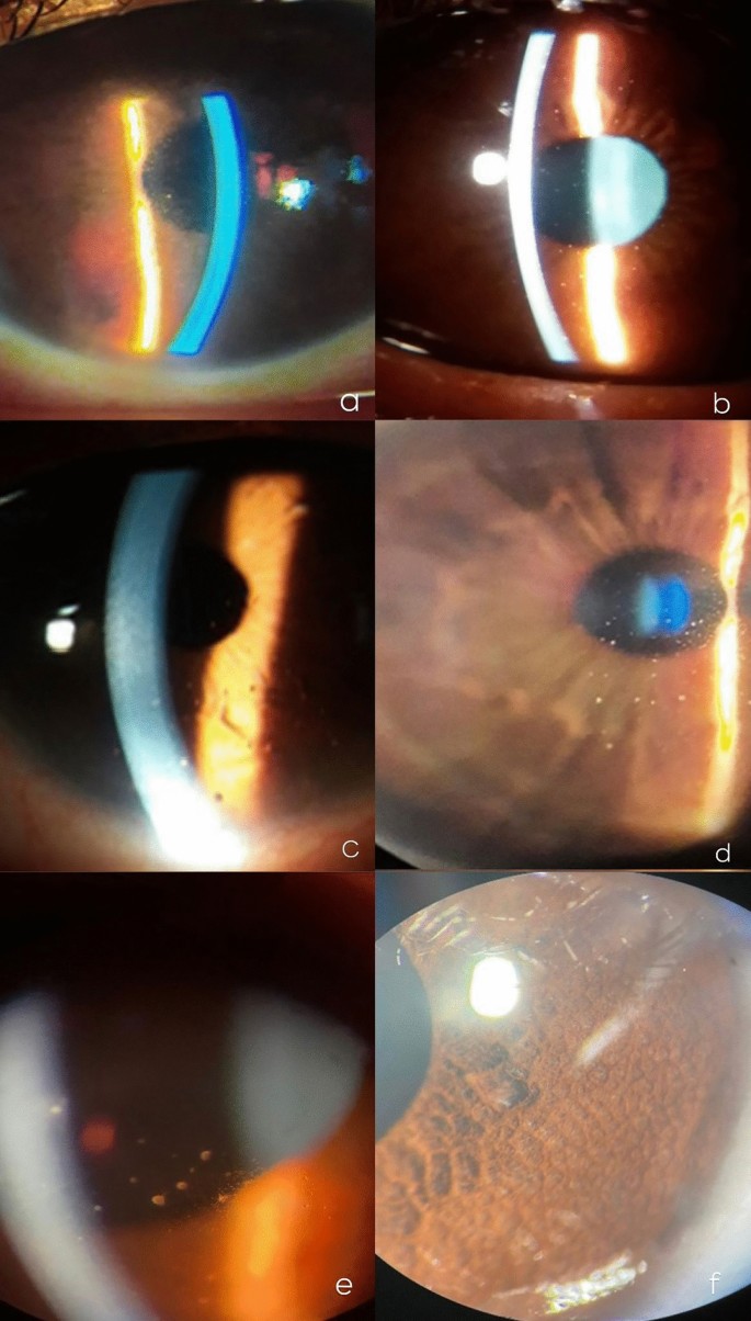 Clinical characteristics and outcomes of twenty patients with ...