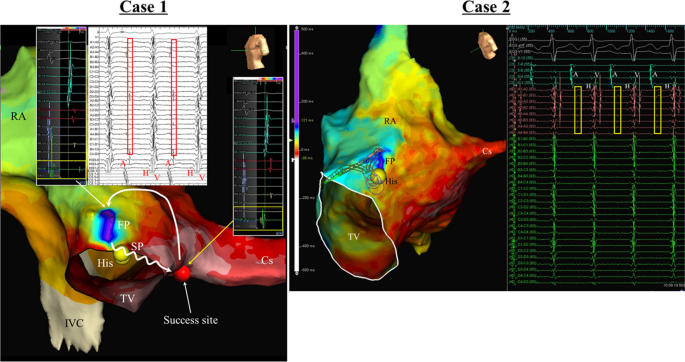 High-density visualization of antegrade fast pathway activation during atypical fast/slow ...