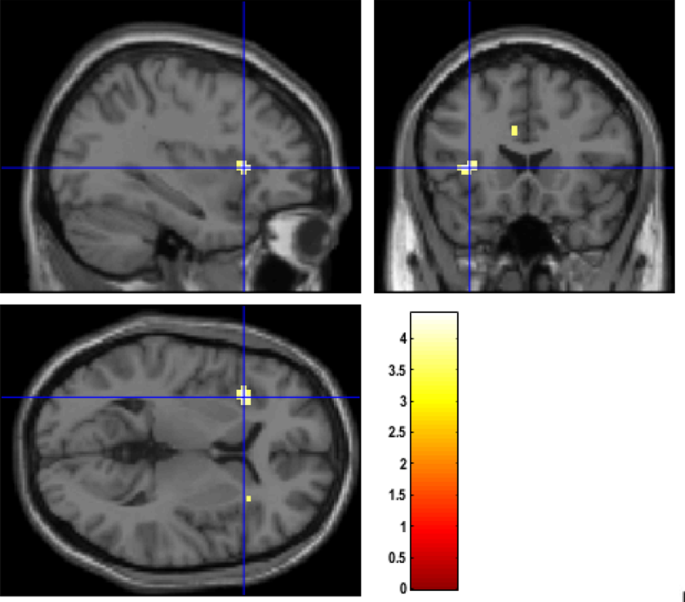Multicomponent Multimethod Assessment of Emotional Change in ...
