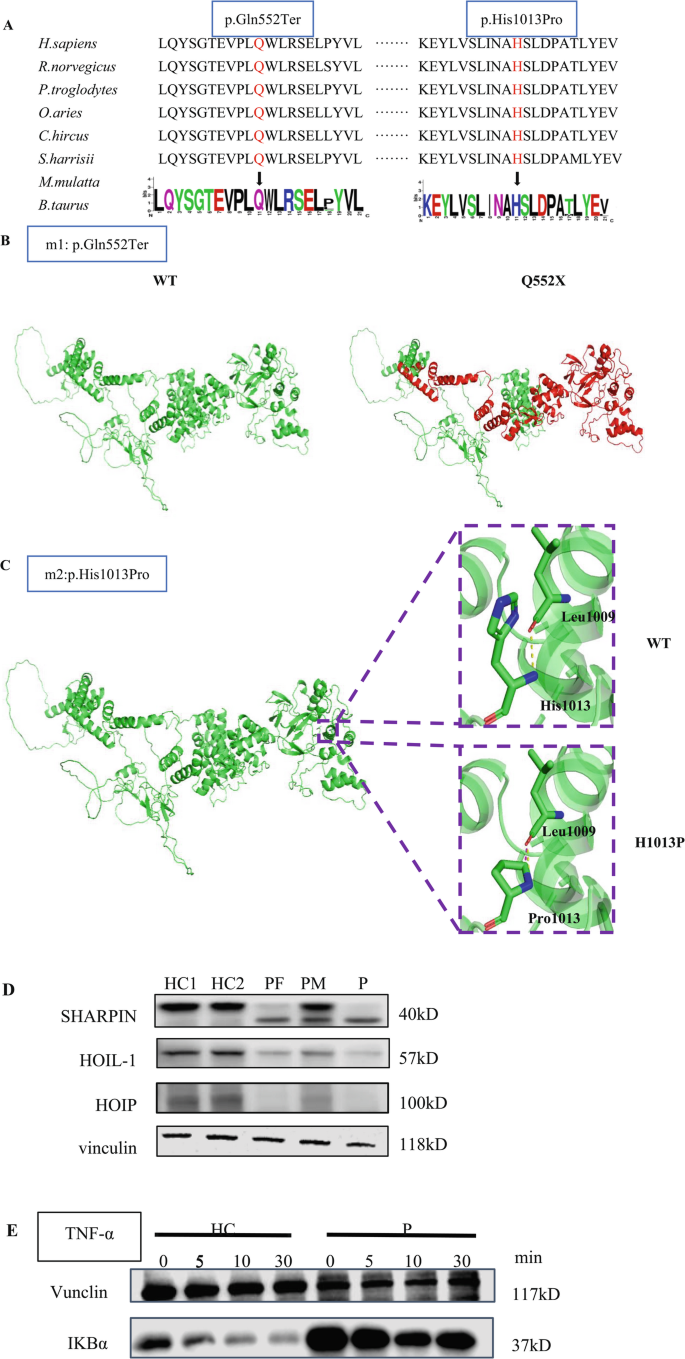Novel Compound Heterozygous Mutations in HOIP Result in ...