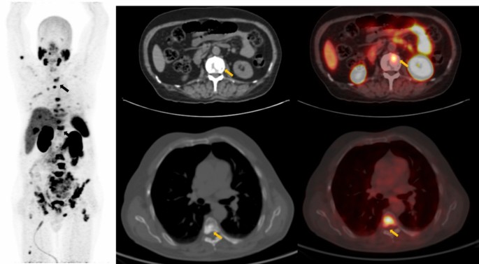 A review of PSMA-based radiopharmaceuticals for diagnosis and therapy ...