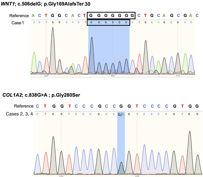 Exome sequencing identified mutations in the WNT1 and COL1A2 genes in ...