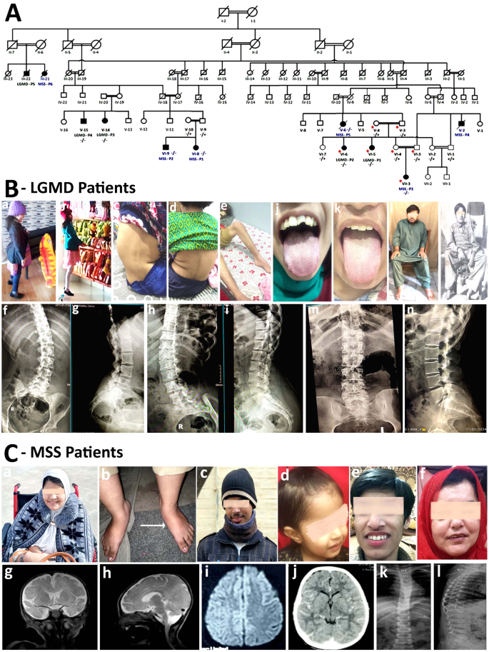 Exome sequencing revealed variants in SGCA and SIL1 genes underlying ...