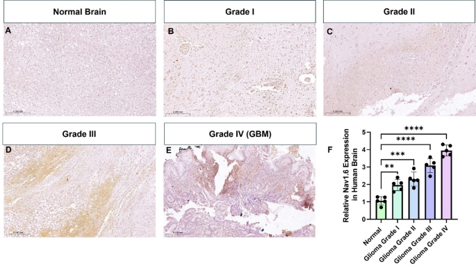 Voltage-Gated sodium channel Nav1.6 mediates glioblastoma proliferation ...