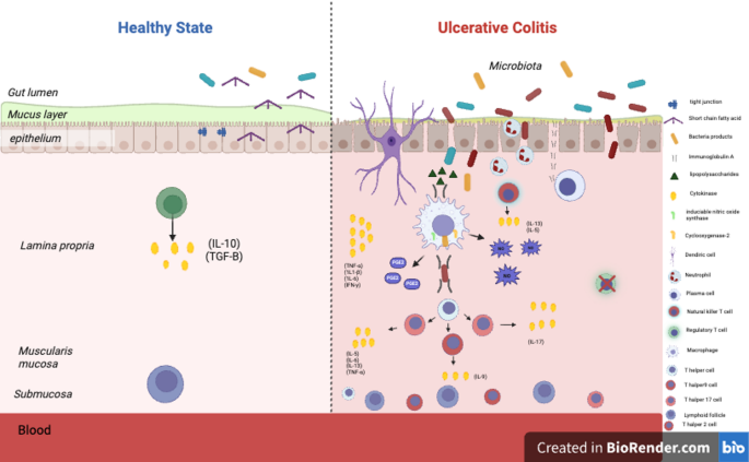 The gut immune axis in ulcerative colitis: insights from microbiome ...
