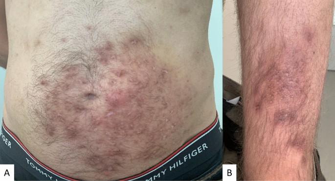 Deep Trichophytosis Mimiking Superinfected Bacterial Folliculitis ...