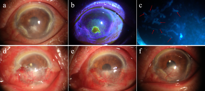 First Isolation of a Multi-azole-Resistant Aspergillus fumigatus cyp51A TR46/Y46F/F70L Mutant in ...