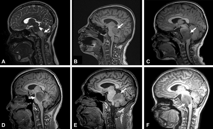 Brainstem tumors may increase the impairment of behavioral emotional ...