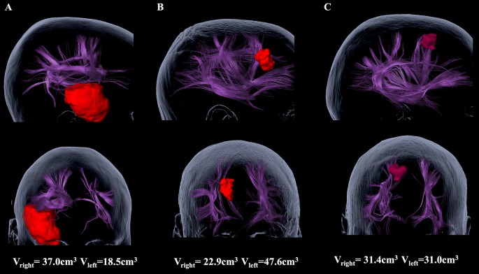 Preoperative nTMS-based mapping of a verbal semantic association task ...