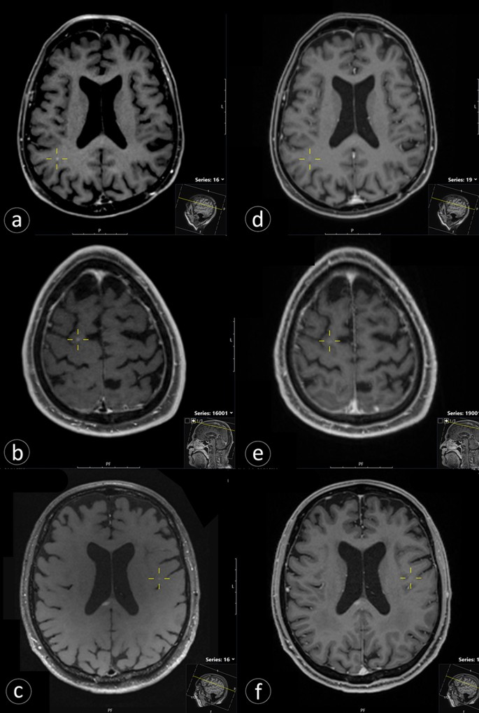 Oncological value of MRI in brain metastasis: exploring the potential ...