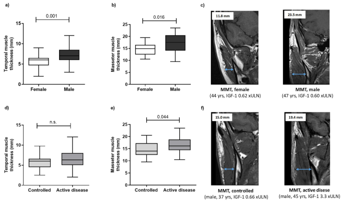 Temporal and masseter muscle evaluation by MRI provides information on ...