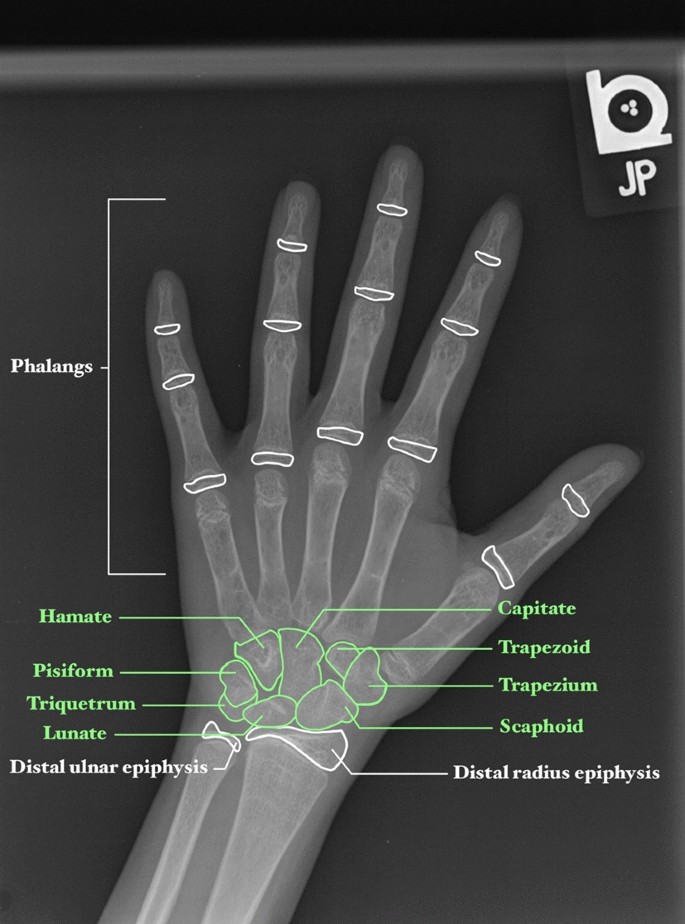 Convolutional neural network-based automated pediatric bone age ...