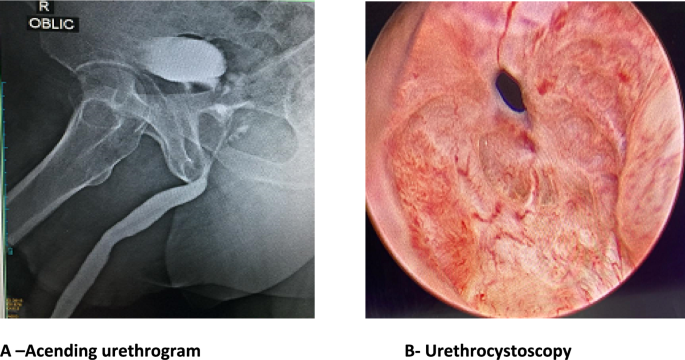 Evaluation of perioperative risk factors for bladder neck contracture ...